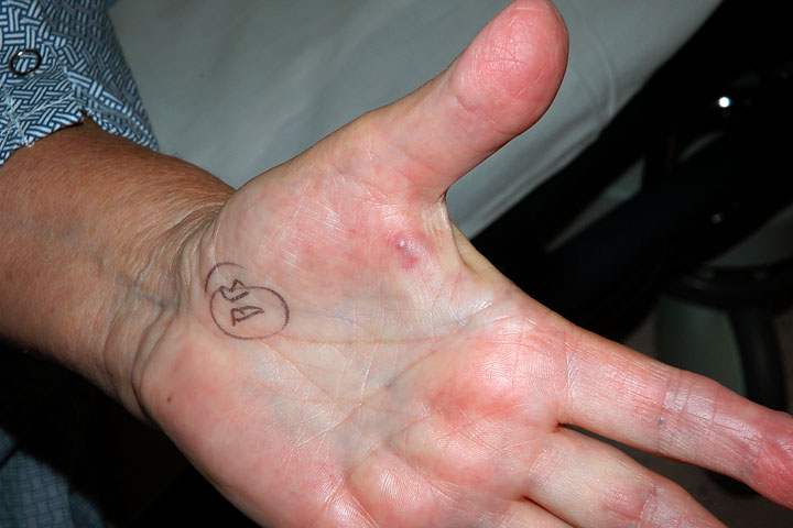 Mami’s Successful Hand Surgery – PAC's Worlds