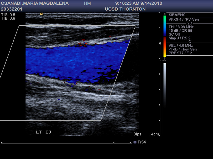 Blood Clot Ultrasound at Sophia Wiseman blog